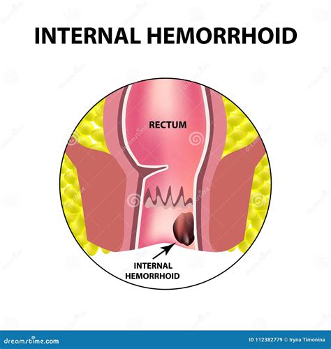 Hemorrhoids Internal Rectum Structure Intestines Colon Internal
