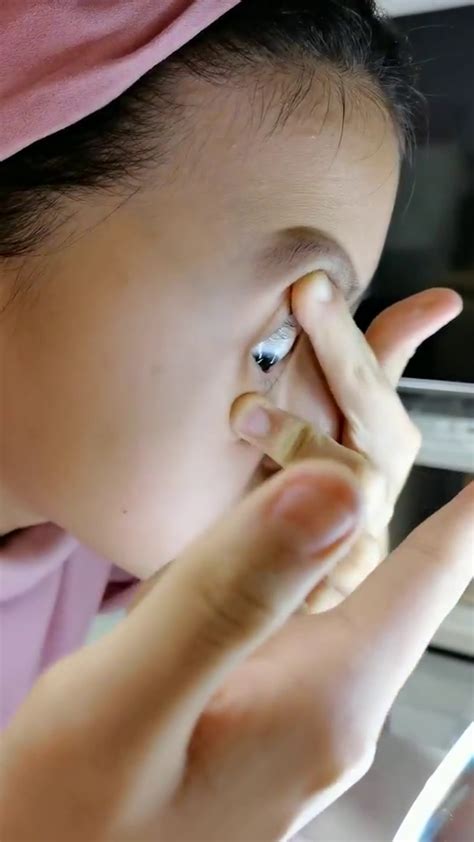 角膜塑形镜戴镜 凤凰网视频 凤凰网