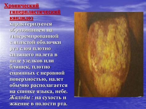 Кандидоз или кандидомикоз СОПР презентация онлайн