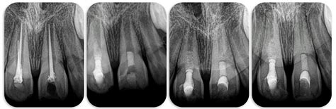 Revascularization Of Immature Permanent Teeth With Apical Periodontitis Style Italiano Endodontics