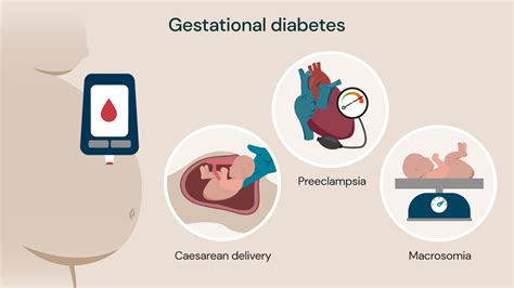How To Avoid Gestational Diabetes Guys And St Thomas Specialist Care