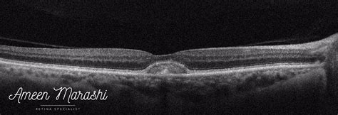 Adult Onset Vitelliform Macular Dystrophy