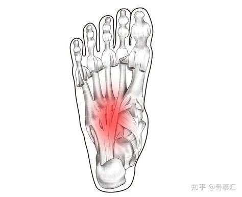 专家支招 脚后跟总是疼痛是什么原因造成的怎么治疗 知乎