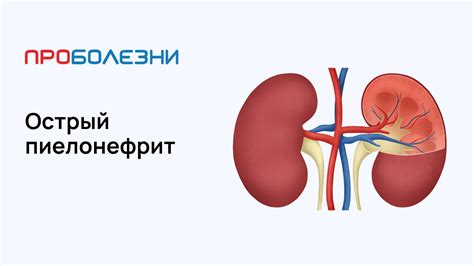 Пиелонефрит причины симптомы лечение
