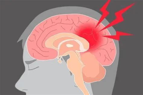 貌似轻微的小中风表现还敢轻易忽视吗 脑医汇 神外资讯 神介资讯