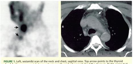 Figure 1 From Asymptomatic Hypercalcemia In A 51 Year Old Woman Semantic Scholar