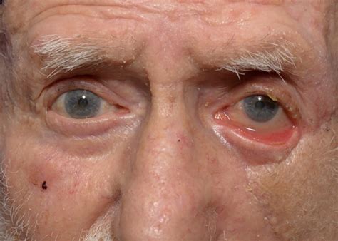 Ectropion Bodla Eye Care
