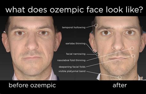 Ozempic For Weight Loss What Is Ozempic Face Newport Beach Plastic Surgery Jonathan Zelken