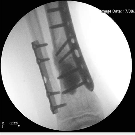 Fluoroscopy Image From Left Tibia And Fibula Orif Orif Open Reduction Download Scientific