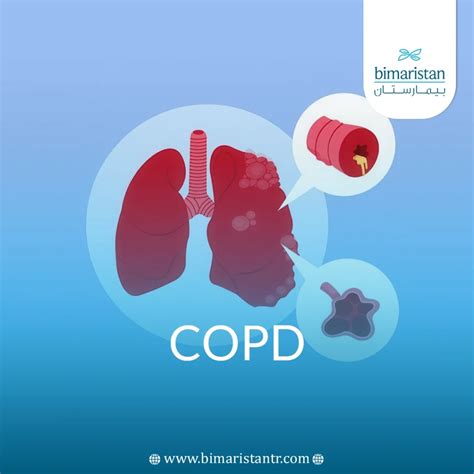 Does Lifestyle Impact Preventing Copd Progression You Should Know About