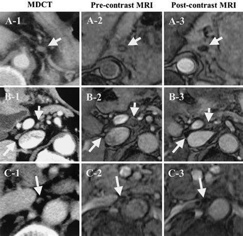 A C Clinical Cases A Perigastric Lymph Node B Retroperitoneal Lymph Download Scientific