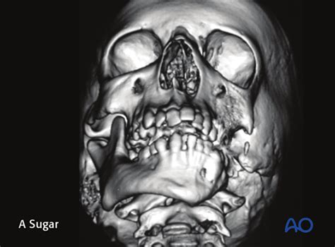 Hemifacial Microsomia Classification