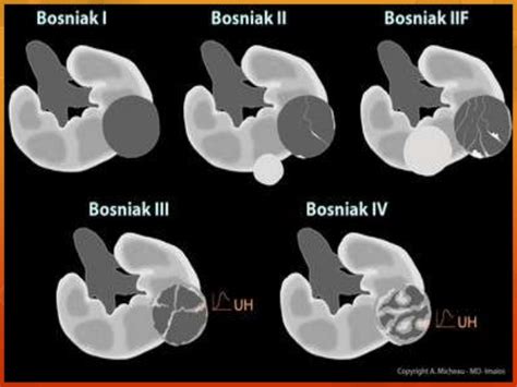 Bosniak Classification And Renal Cystic Disease Radiología