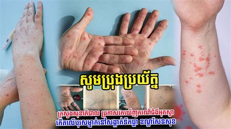 ដំណឹងក្ដៅៗ ក្រសួងសុខាភិបាល ប្រកាសរកឃើញករណីជំងឺអុតស្វា