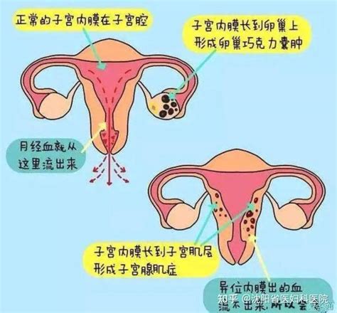 子宫肌瘤和子宫腺肌症的区别 知乎