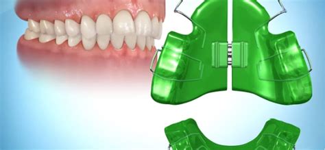 Twin Block Norwest Orthodontics