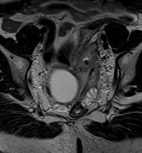 Plan Bladder T2 Coronal Mrimaster