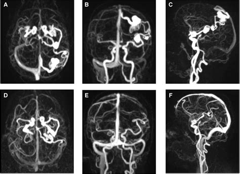 Twist Mr Angiography Before And After Bavm Elimination Ac Axial