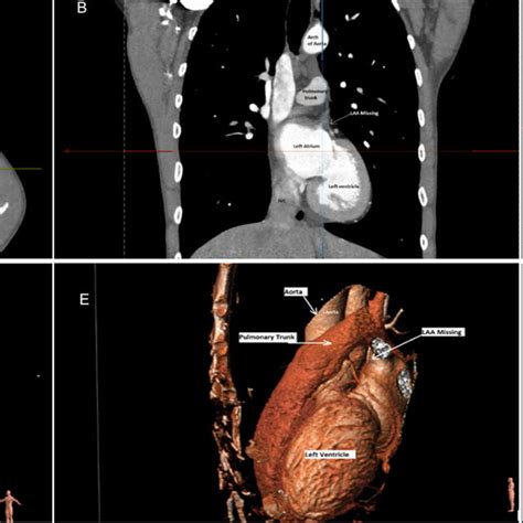 Pdf Congenital Absence Of Left Atrial Appendage