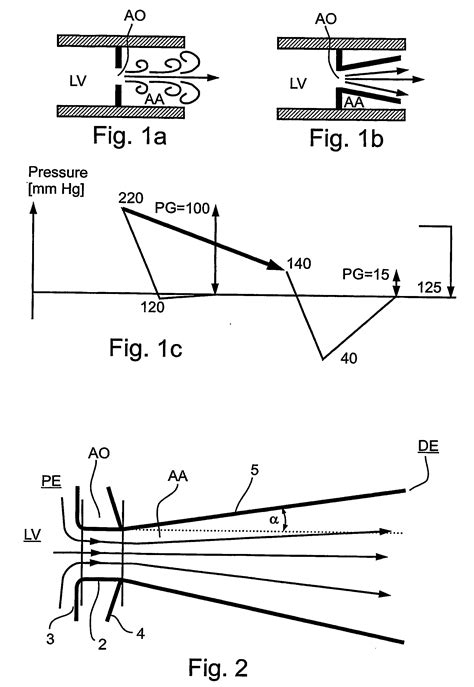 Prosthetic Valve Patented Technology Retrieval Search Results Eureka Patsnap