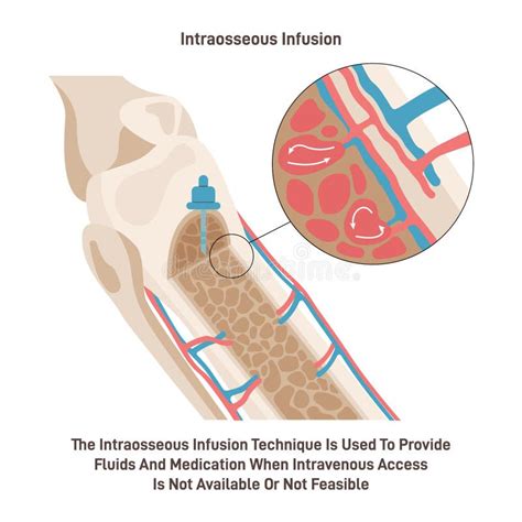 Intraosseous Injection Stock Illustrations Intraosseous Injection Stock Illustrations