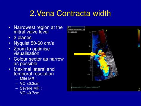 Ppt How To Diagnose And Assess Severity Of Mitral Regurgitation By Echo Powerpoint