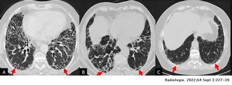 Idiopathic Pulmonary Fibrosis Radiología English Edition