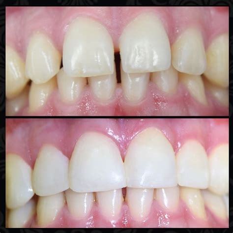 kalon dental gaps be gone if you have unwanted spacing