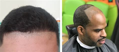 How To Fix Your Hairline 9 Ways To Get It Back On Track