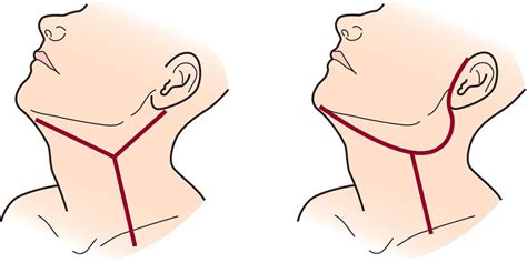 Radical Neck Dissection Thyroid Surgery And Radical Neck Dissection