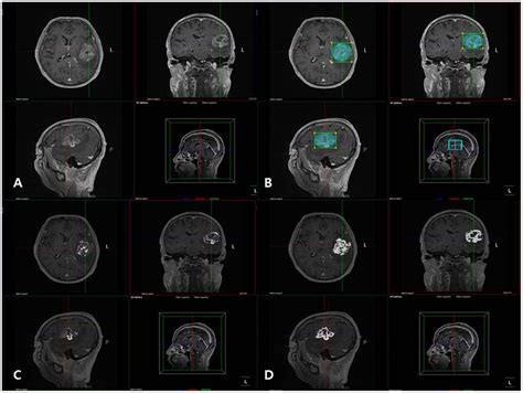 Clustering Method Was Used As A Semi Automatic Segmentation Of