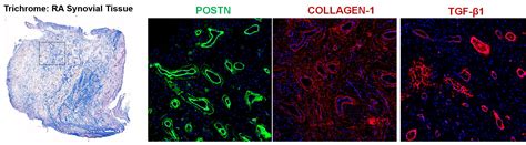 Spatial Transcriptomic Analysis Reveals Vascular Zonation Of Myofibroblasts In Rheumatoid