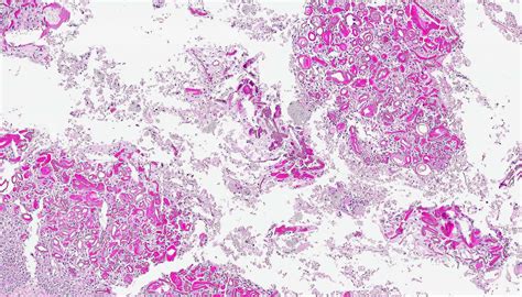 Radicular Cyst Pathology Outlines Pathology Outlines Dermoid Cyst
