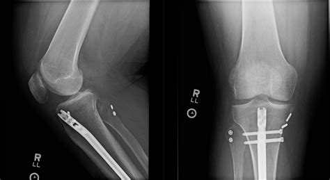 Operative Treatment Of Acute Traumatic Dislocation Of The Proximal Tibiofibular Joint With