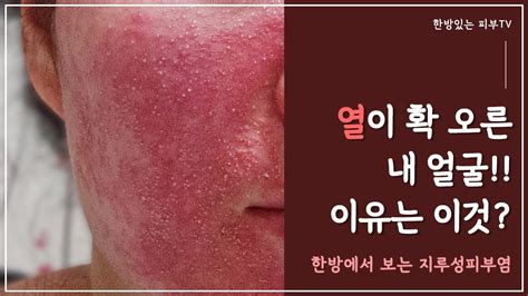 홍조 주사 지루성 얼굴에 열이 확 오른 내 피부 한의원에서 치료하는 방법 Youtube
