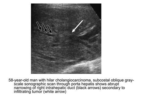 Diagnostic Imaging Of Cholangiocarcinoma Ppt Digestive Disorders Diseases And Conditions