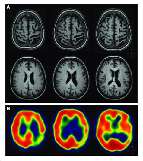 A T1 Weighted Axial Mr Image Of The Brain Showing Diffuse Cortical