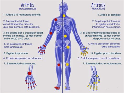 Abre Los Ojos Artrosis Artritis Reumatica Artritis Psoriasica Y