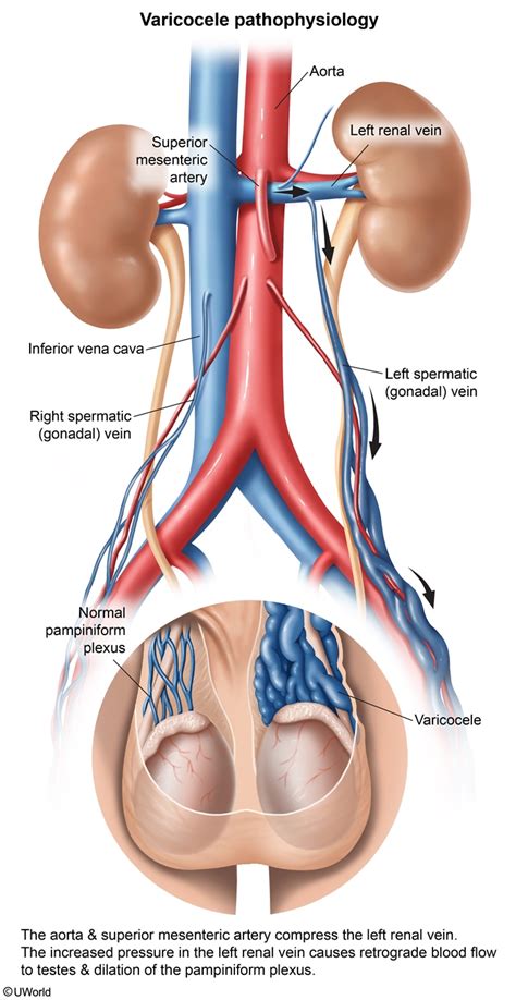 Varicocele Male Reproductive System Uworld Medical Library
