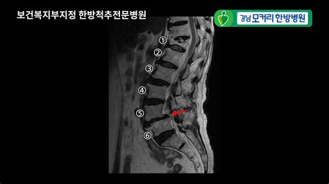 척추전방전위증을 동반한 추간공협착증으로 한 걸음도 떼기 힘든 환자의 비수술 재활치료 사례 강남모커리한방병원 척추관협착증센터