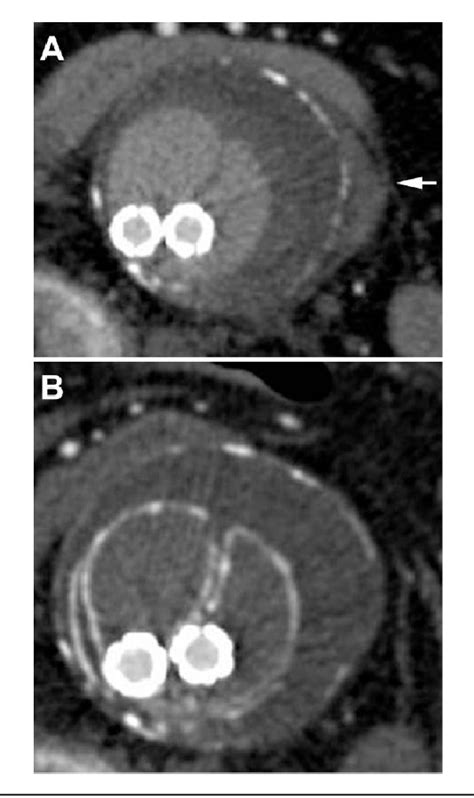 Figure 27 From Imaging After Nellix Endovascular Aneurysm Sealing Semantic Scholar