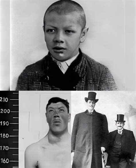 Ancient Adam Rainer Was An Austrian Man Whose Medical History Is