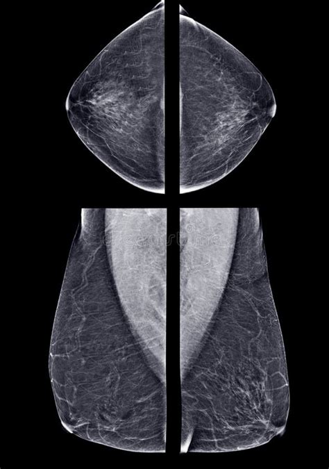 X Ray Digital Mammogram Or Mammography Of Both Side Breast Cc View And
