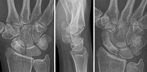 Scaphoid Fracture X Ray Lateral At Carolyn Lafleur Blog