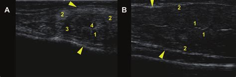 5 Sonograms Of Transverse A And Longitudinal B Sections Of A
