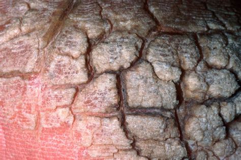 Hyperkeratosis Of The Heel Hyperkeratosis Describes A Thickening Of