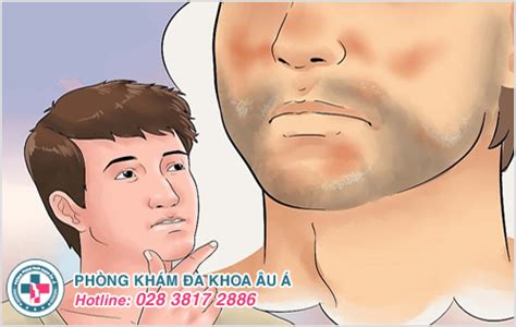 Vảy Nến ở Mặt Nguyên Nhân Dấu Hiệu Và Cách điều Trị