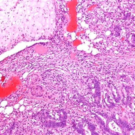 The Mucus Of Caliciform Cells In Normal Tissue Is Colored In Intense