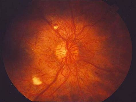 Doxycycline Double Duty In Eye Disease