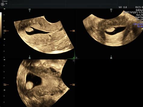 Endometrial Polyp Ultrasound And Sis The Gold Standard Empowered Women